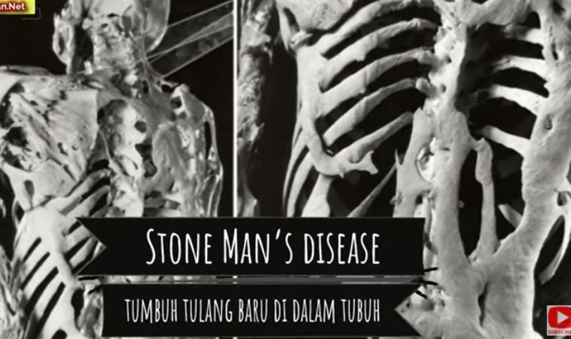 5 Penyakit Langka dan Paling Aneh yang Ada di Dunia